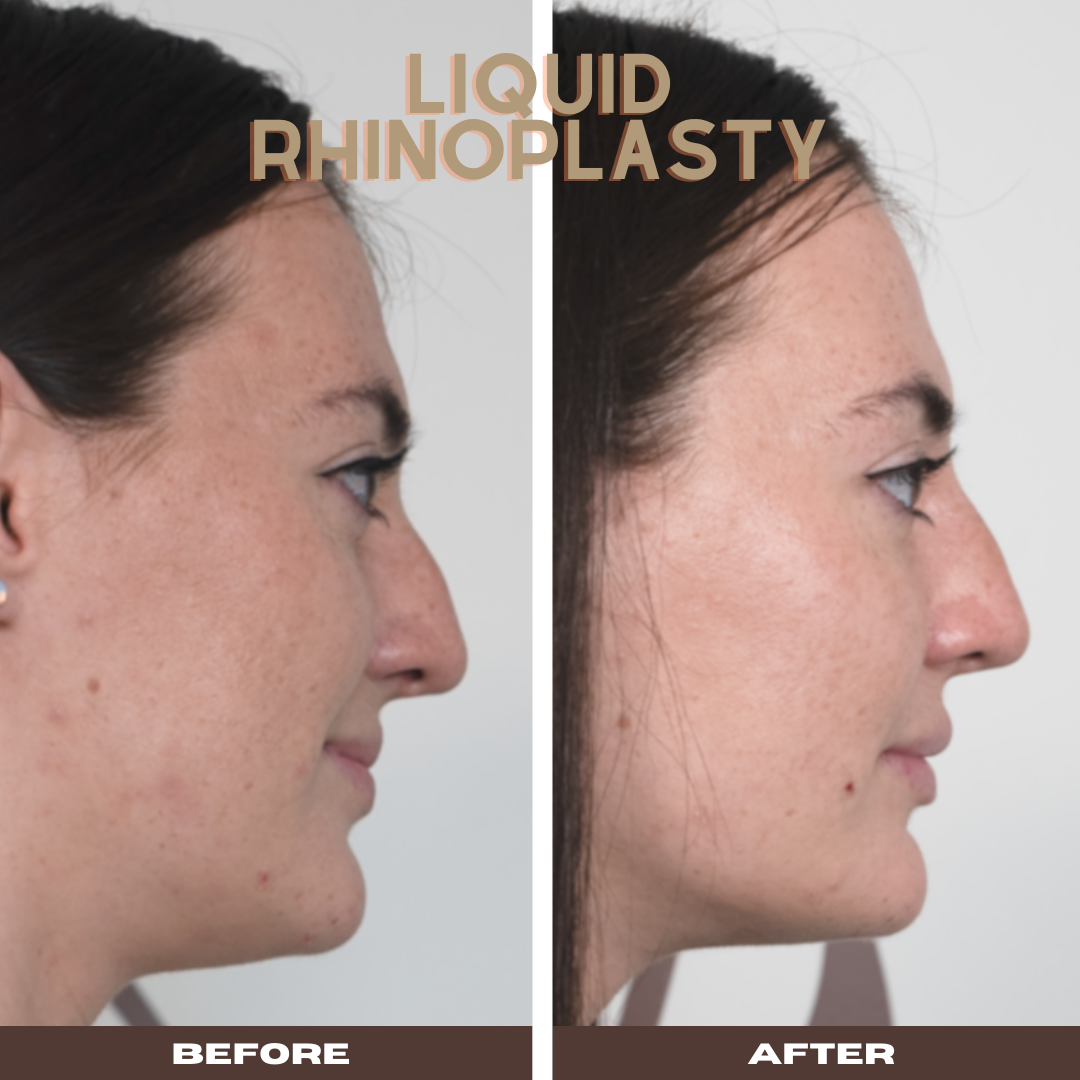 Receive a $100 Towards Your Lip Injections!