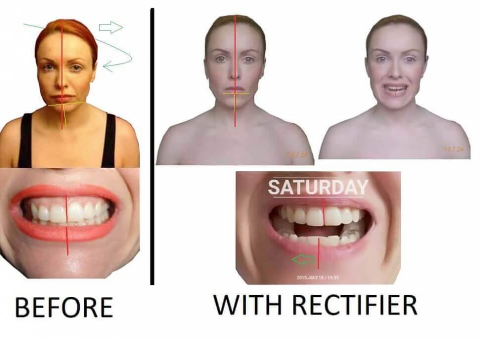 Revolutionary Rectifier for Body Symmetry