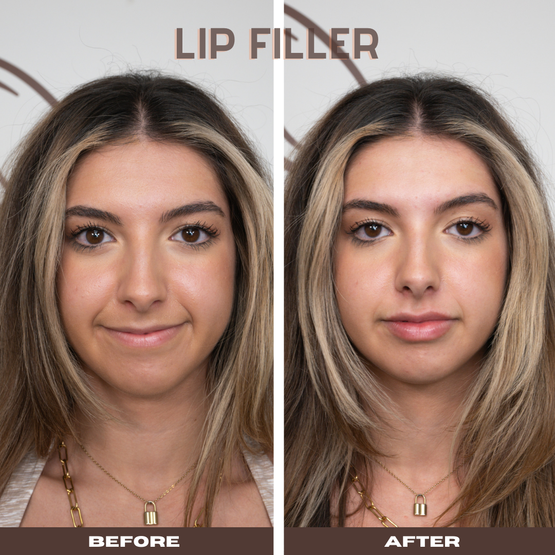 Receive a $100 Towards Your Lip Injections!